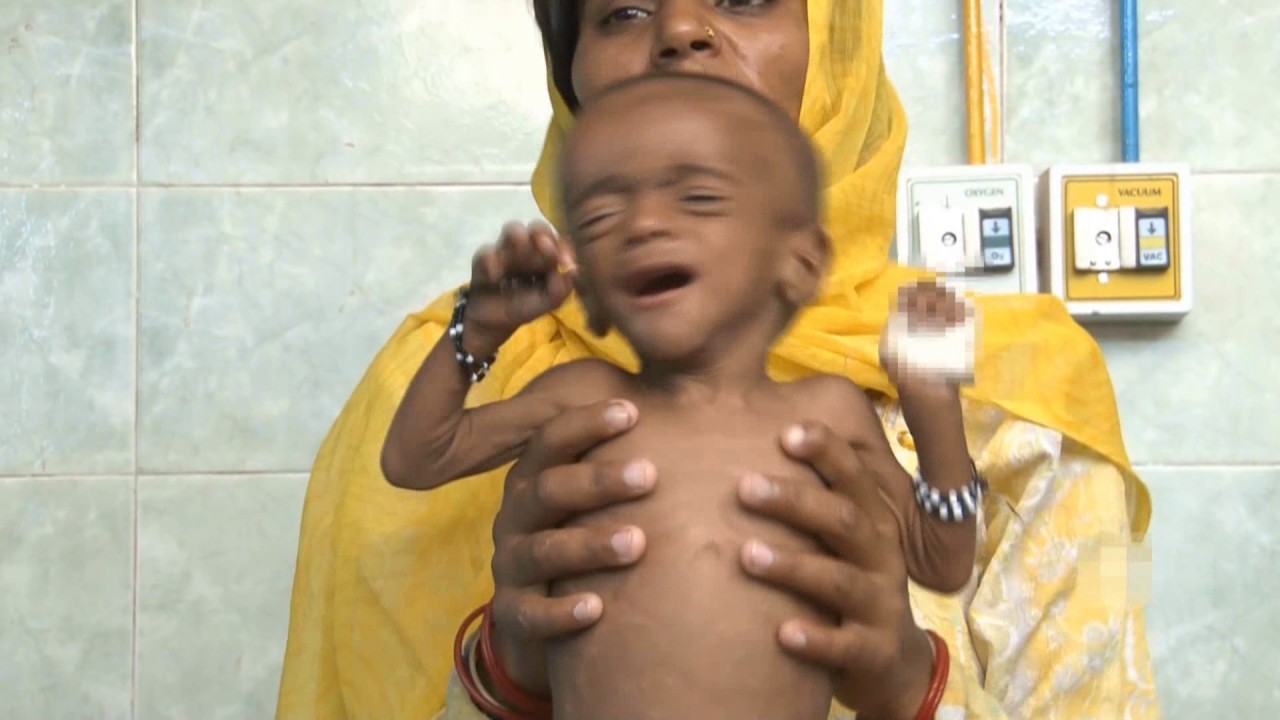 Clinical Signs- Identification of SAM Children- NNRRTC, KSCH - YouTube