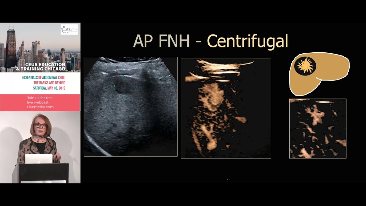 The fundamentals for interpretation of liver CEUS - YouTube