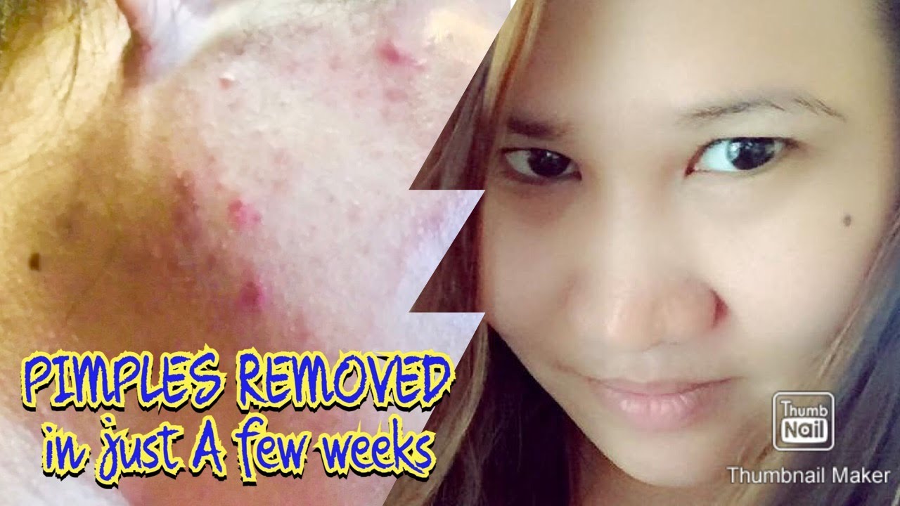 HOW TO CURED PIMPLES IN JUST Few Weeks - YouTube