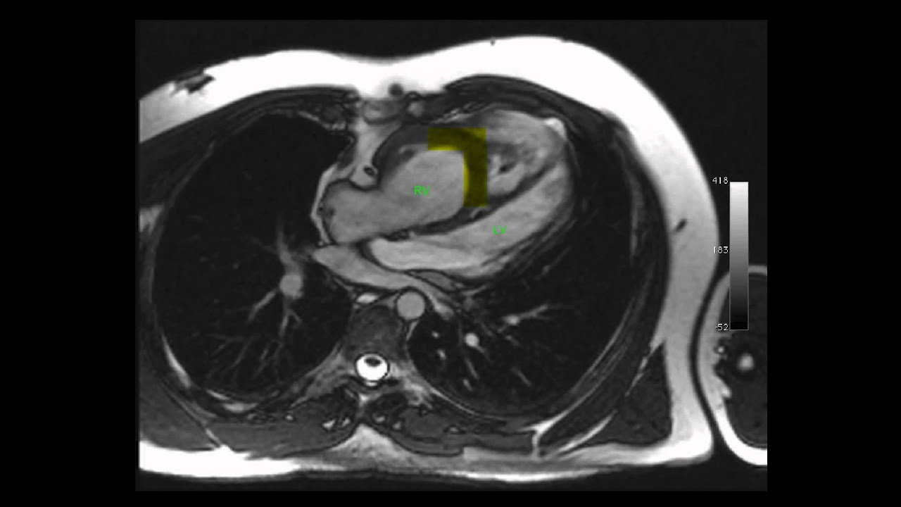 dextro-Transposition Great Arteries - YouTube