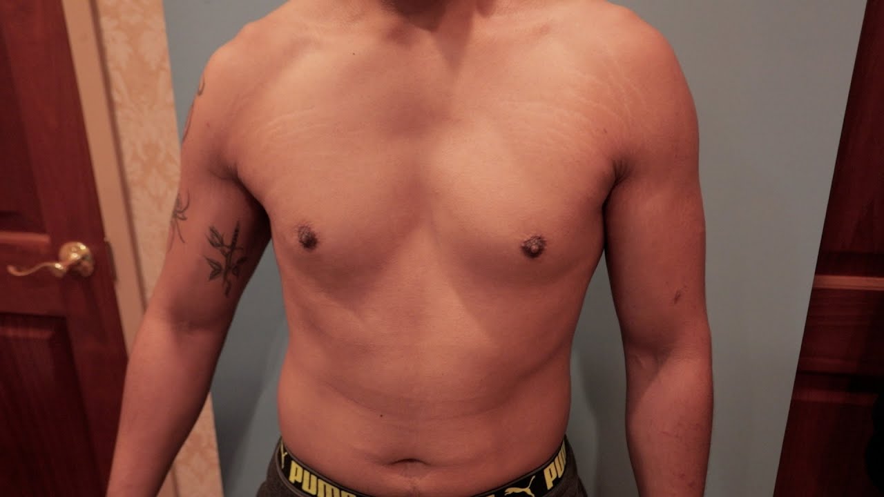 GYNECOMASTIA SURGERY: NEW YORK MALE GLAND REMOVAL - YouTube