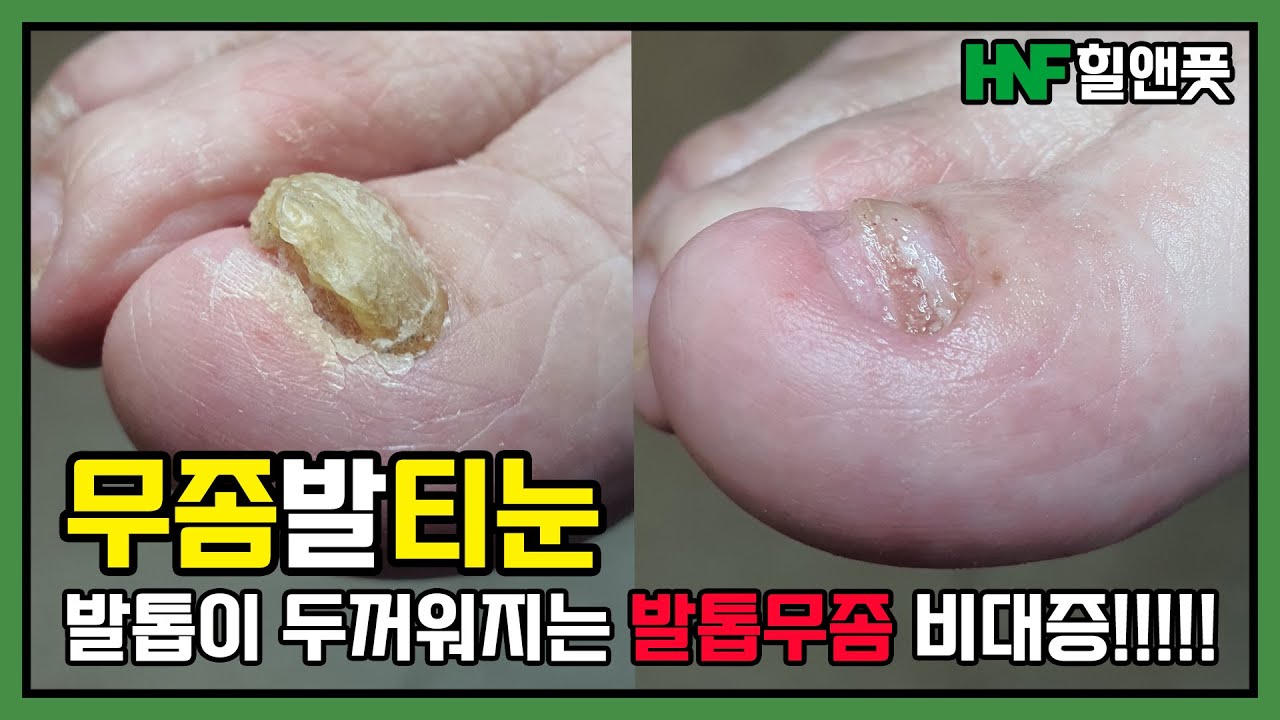 [ASMR] 무좀발티눈 :: Fungal Foot Corn :: 티눈 :: Corn :: 무좀 :: Athlete's foot ...