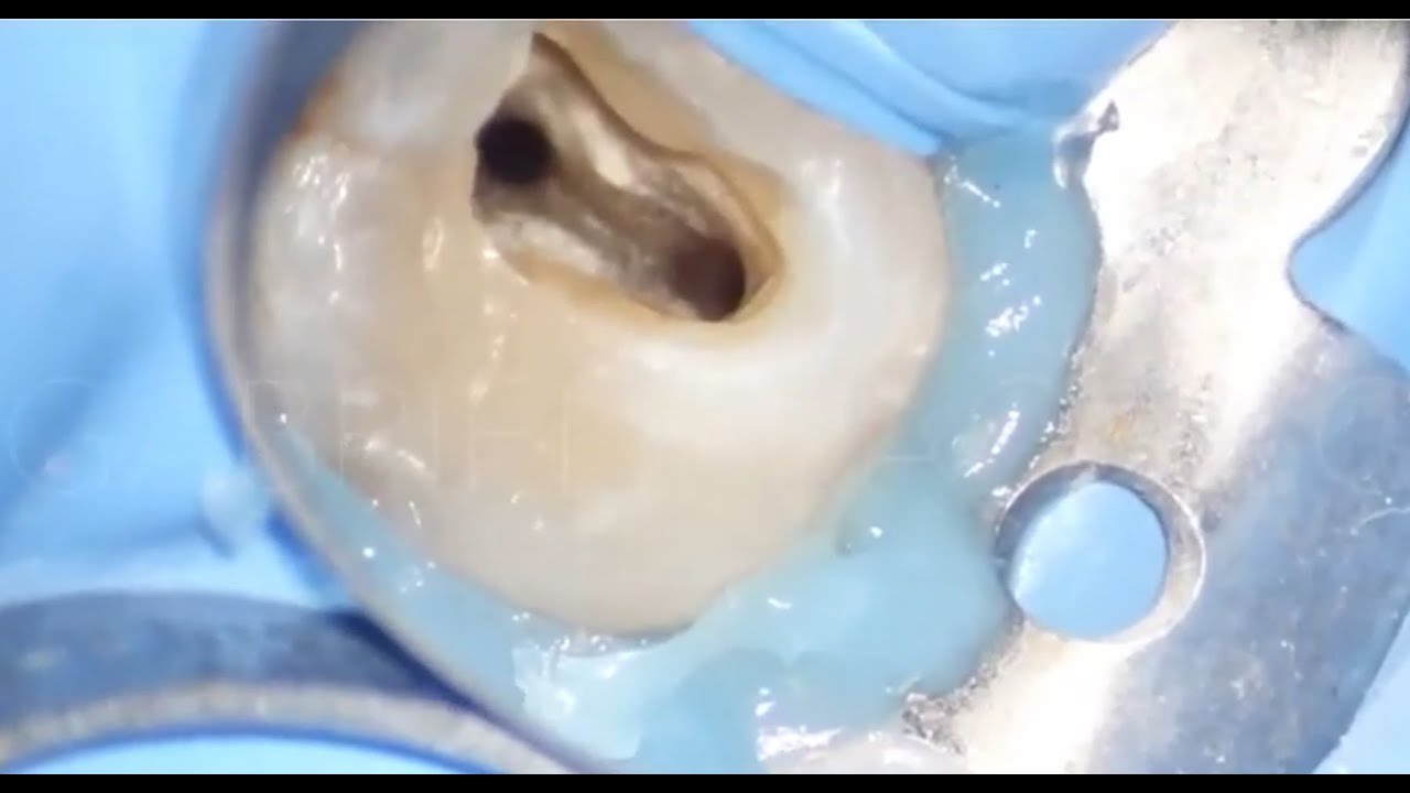 Endo Guide with Blue Sky Plan - YouTube