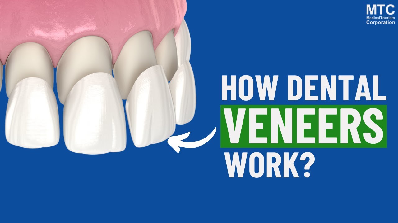 Dental Veneers Procedure: A QUICK Guide to Your PERFECT Smile! - YouTube