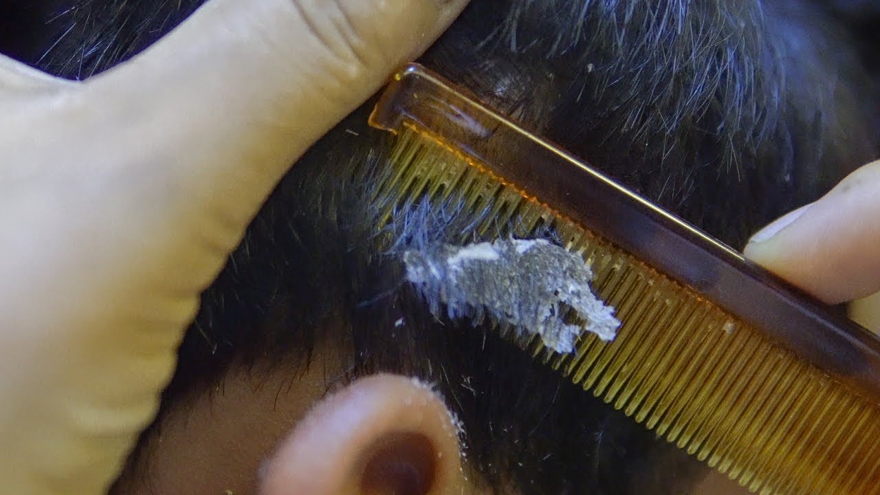 Dandruff Scratching On Right Side of Head! (Big Flakes) - YouTube