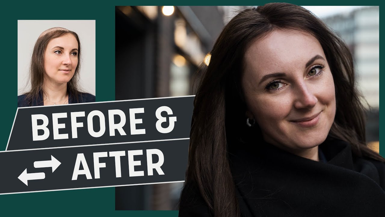 Genetic hair loss in women: That’s how a permanent wig helps ...