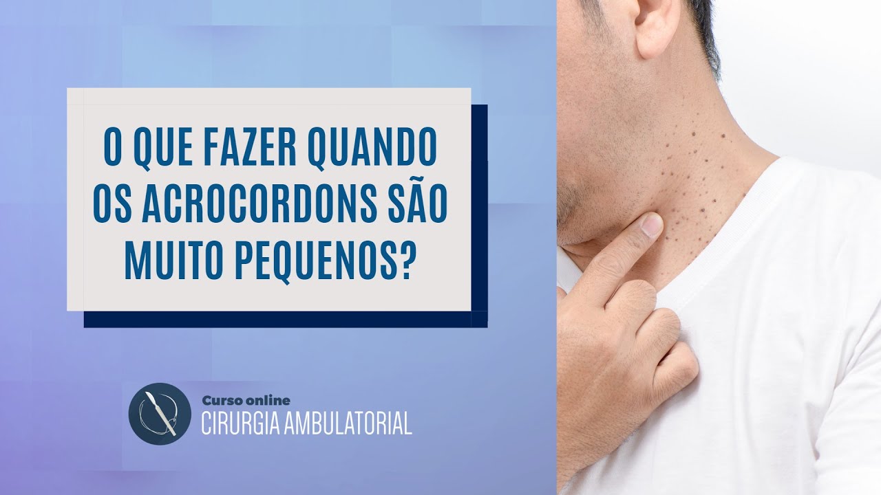 O que fazer quando os acrocórdons são muito pequenos? - YouTube