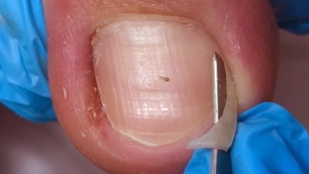 The ingrown nail goes deep into the root and can be removed with one ...