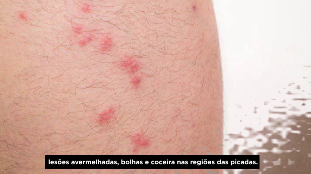 Picada de insetos - YouTube