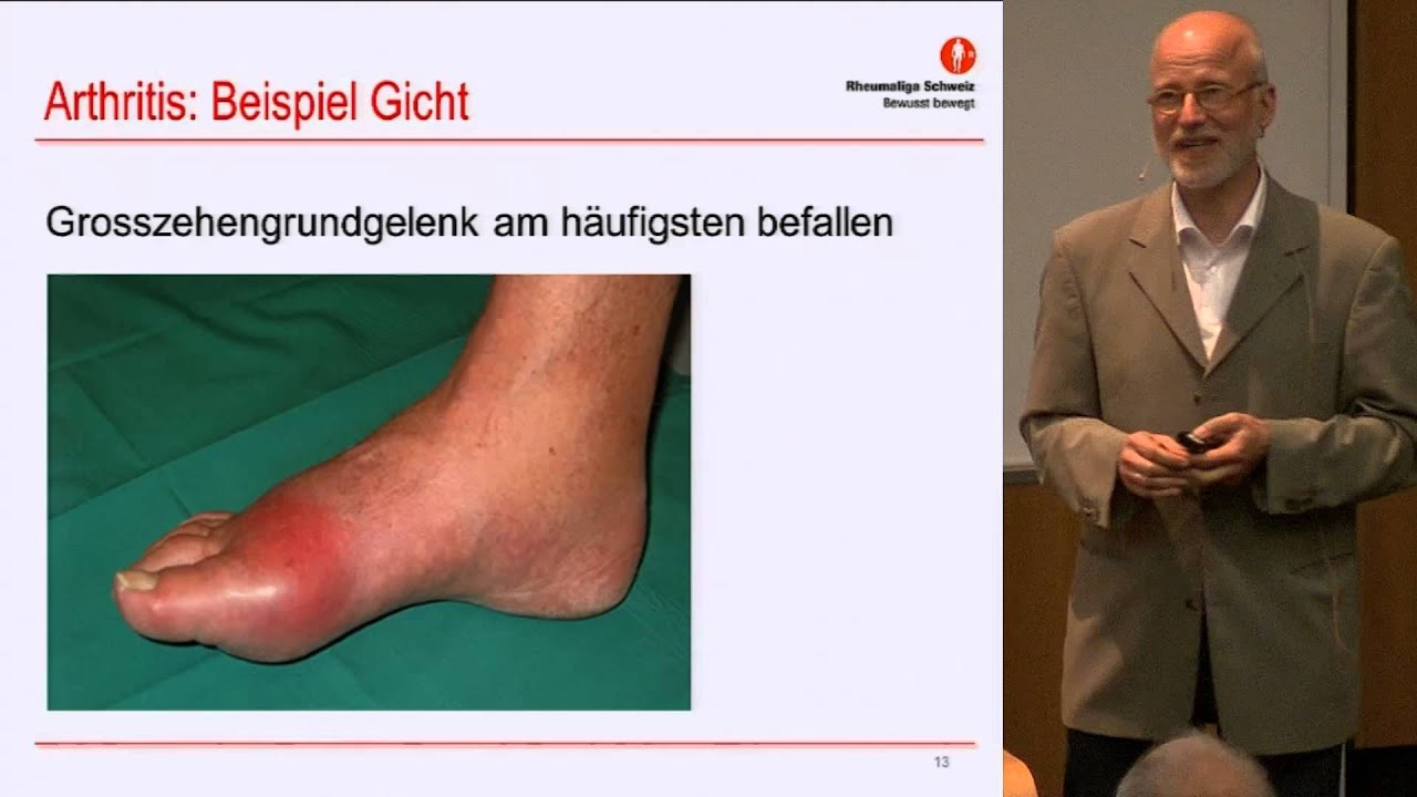 Rheumatische Fussbeschwerden - YouTube