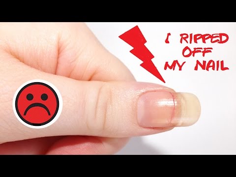 I Ripped Off My Nail ! 😢 - YouTube