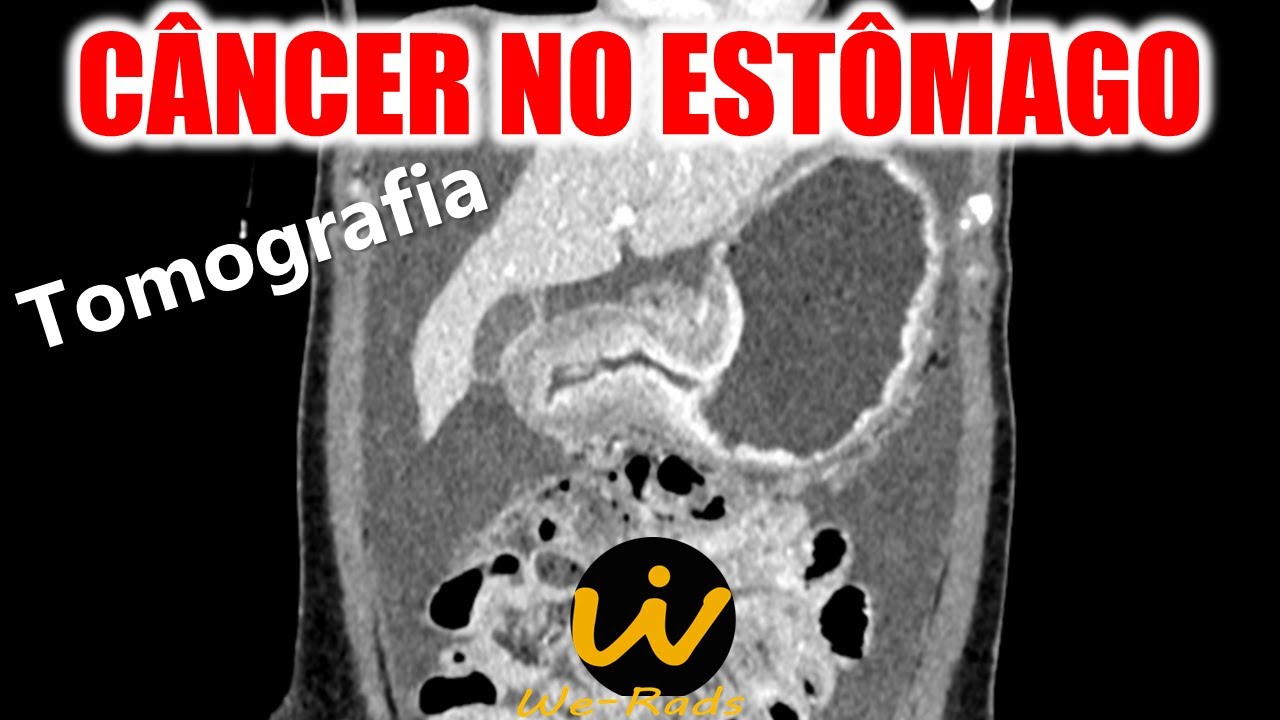 CÂNCER no ESTÔMAGO - Neoplasia Gástrica Avançada na Tomografia - YouTube