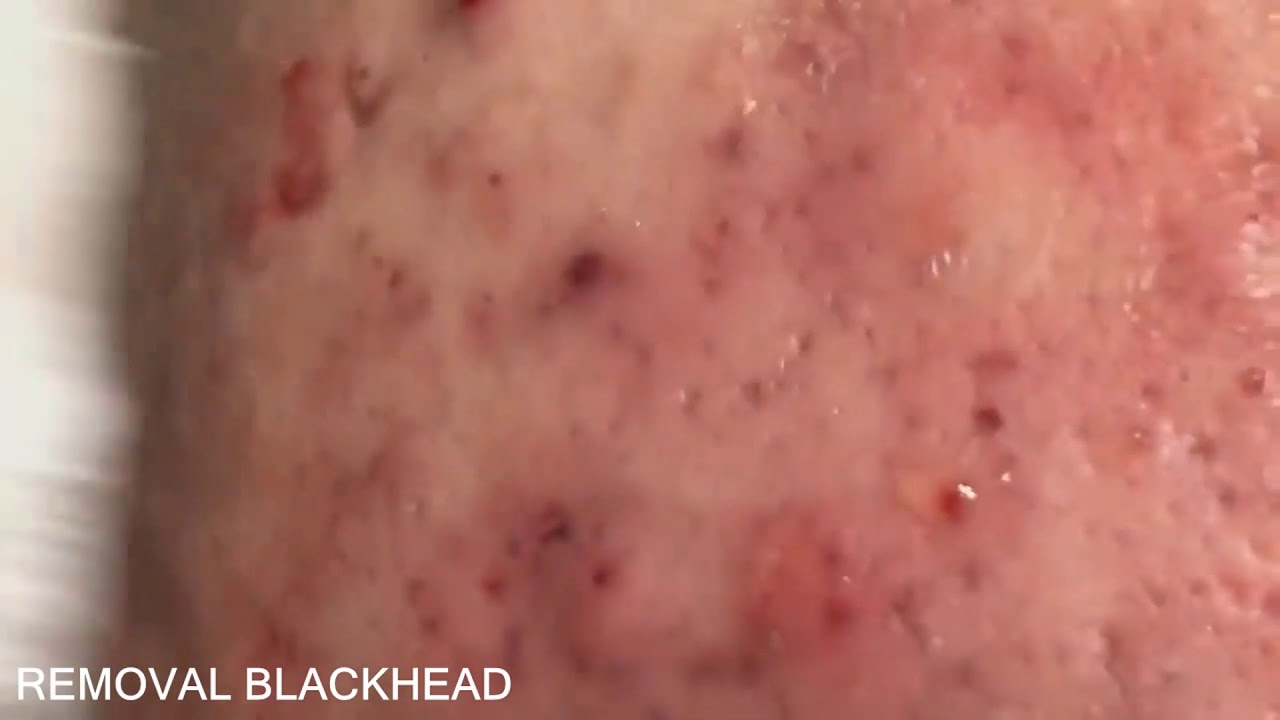 Popping Tons Of Blackheads Part 06 - YouTube