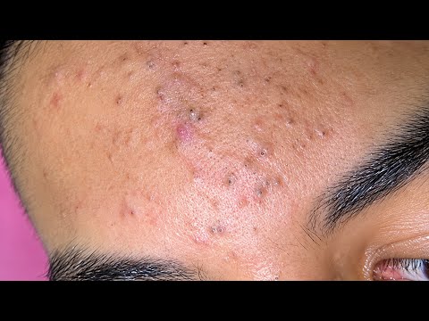 Die ultimative Routine zur Tiefenreinigung der Poren | Extrem befriedigende Akne-Behandlung für e...