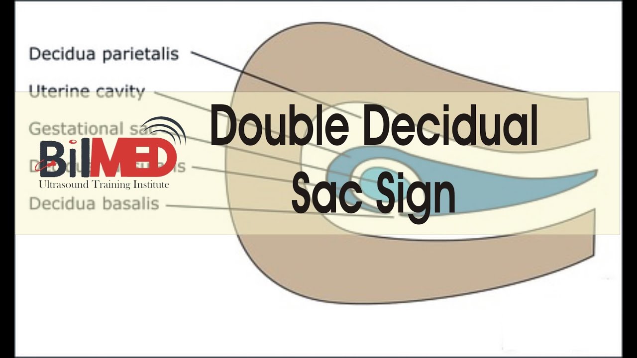 DOUBLE DECIDUAL SAC SIGN | Vlogs | BilMed USG Training - YouTube