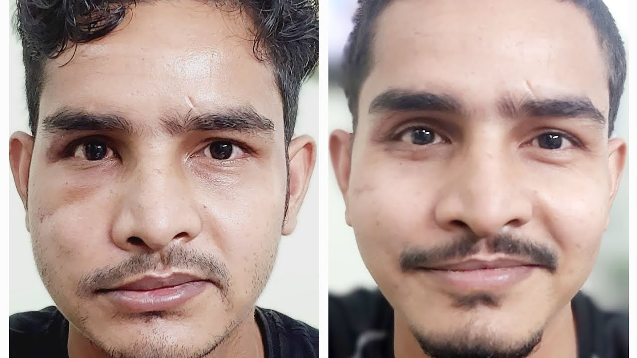 Facial Deformity Surgery ! - YouTube