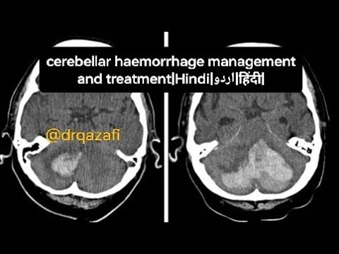 cerebellar haemorrhage diagnosis management and treatment|Hindi|हिंदी ...