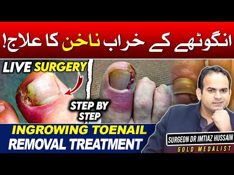 Ingrowing Toe Nail | Treatment and Causes | Operation | After care ...
