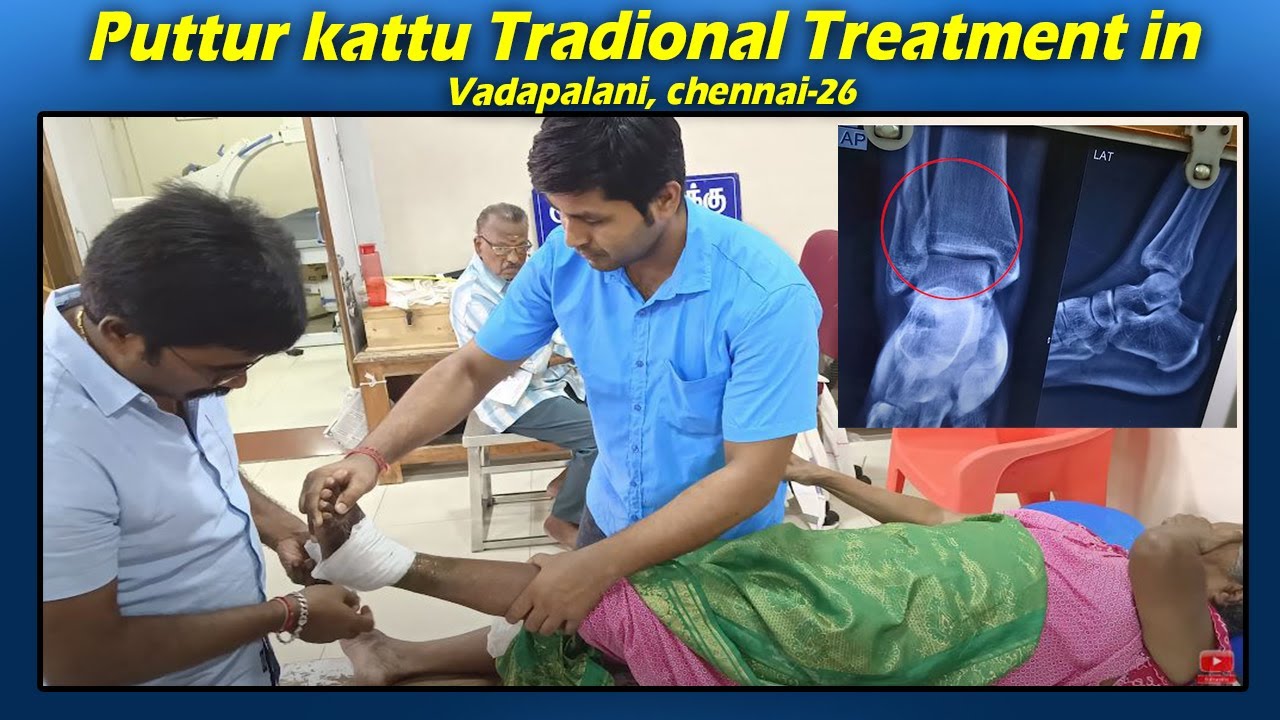 Puttur kattu a tradional treatment in Vadapalani,chennai Dr.R.S ...
