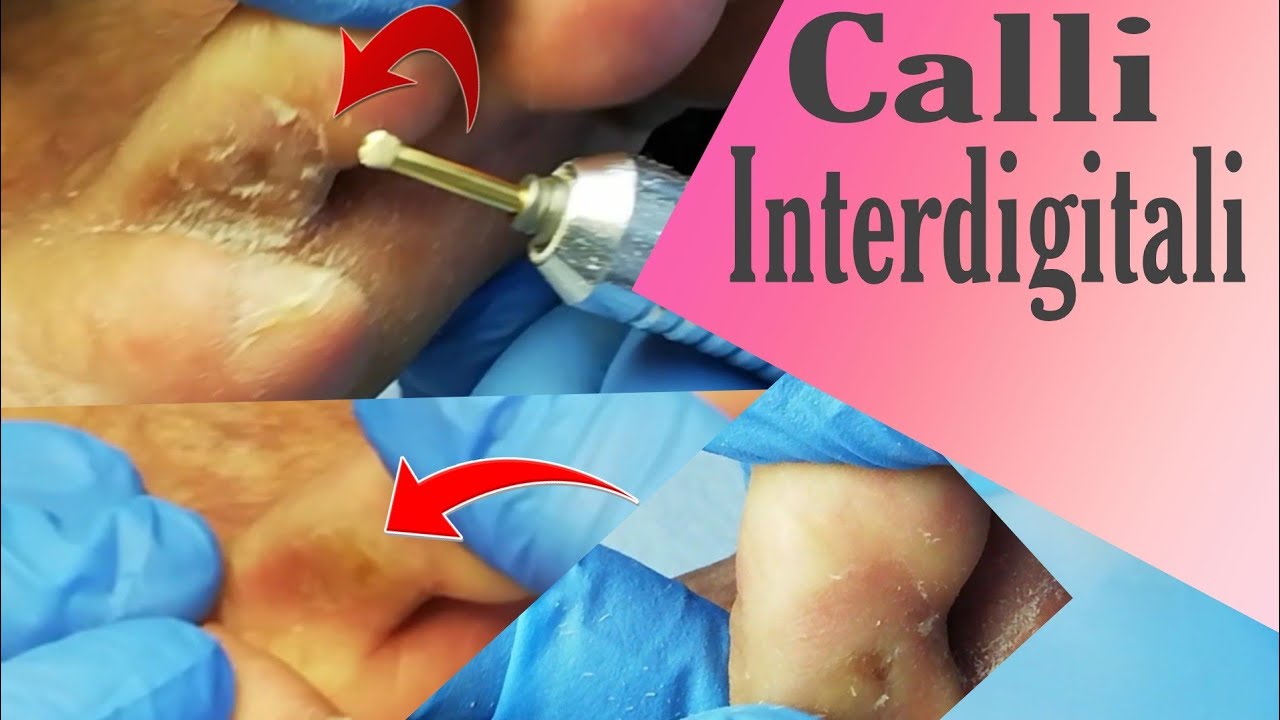 [Calli interdigitali e iperchratosi] tutorial/ - YouTube