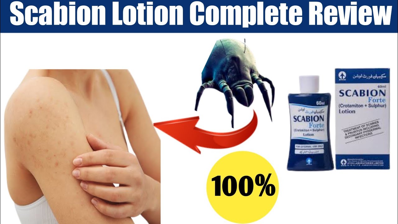 Scabies Ka elaj | Scabies Home Treatment | Scabion lotion use | متعدی ...