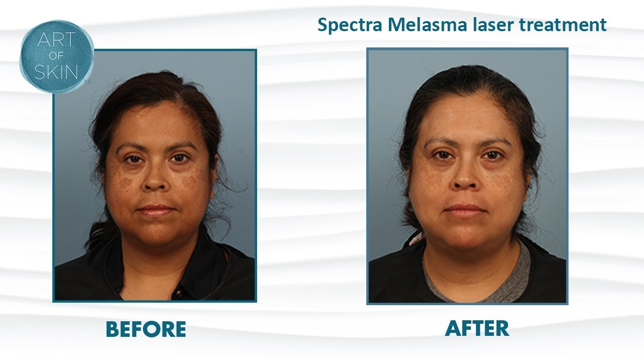 Spectra Melasma laser treatment California at Art of Skin MD - YouTube