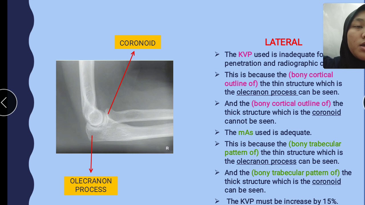 RADIOGRAPHIC IMAGE EVALUATION OF AP/LATERAL ELBOW - YouTube