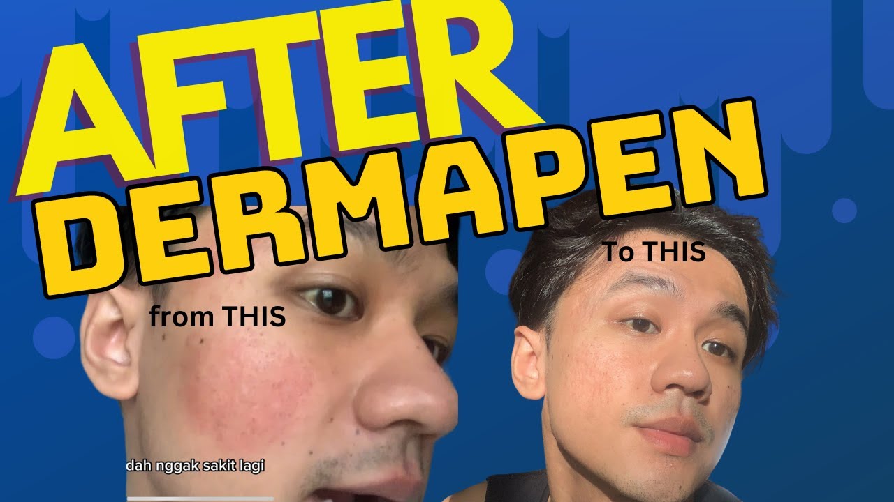 #update DERMAPEN SENDIRI DI RUMAH ke 12 | microneedling update and ...