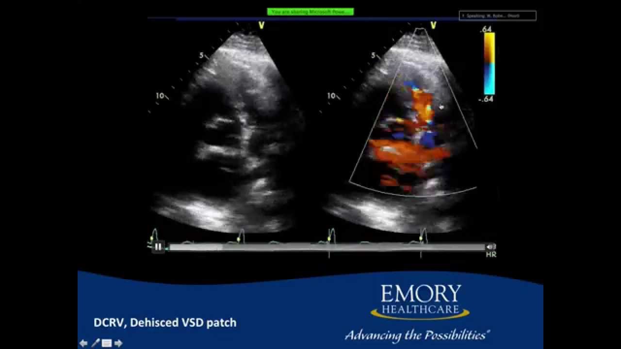 Emory Cardiology Grand Rounds 09-22-2014 - YouTube