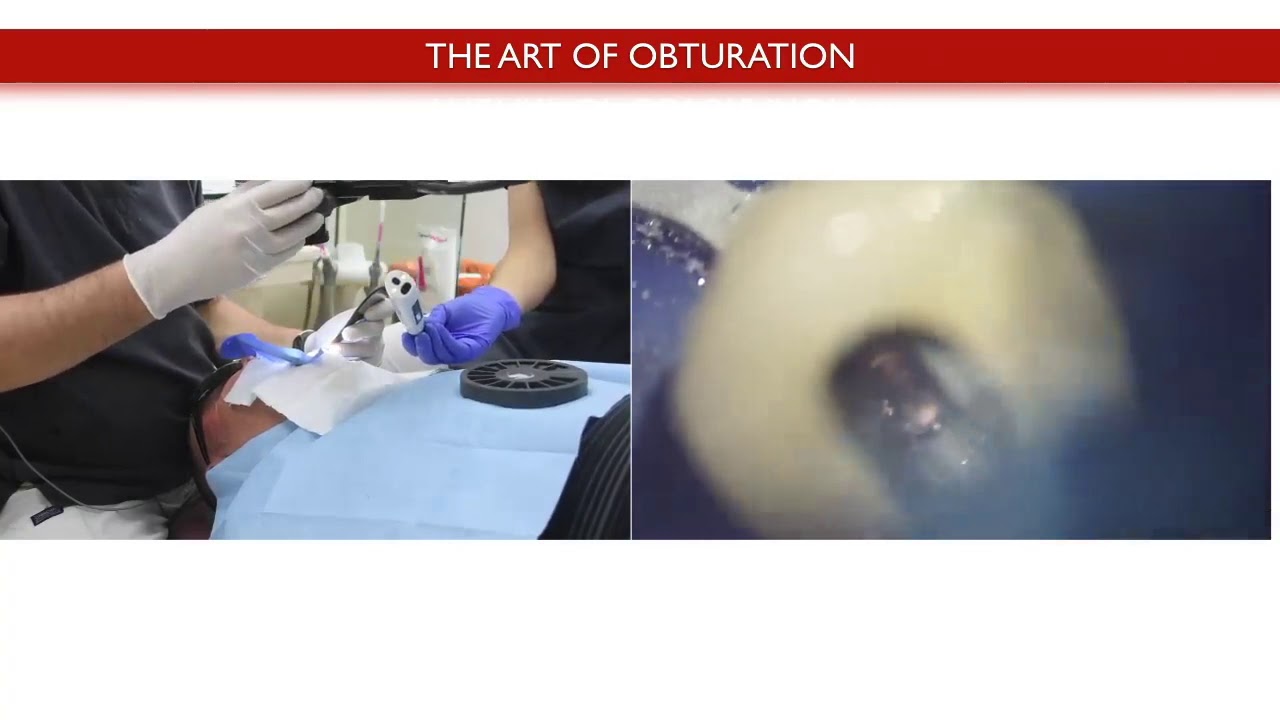 Eighteeth Fast-Pack Clinical Case by Dr.Massimo Giovarruscio - YouTube