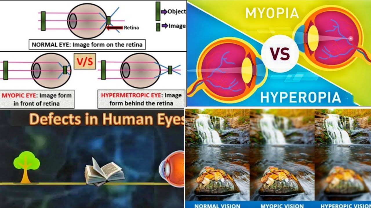 eye defects।। myopia।। hypermetropia।। human eye।। human eye and ...