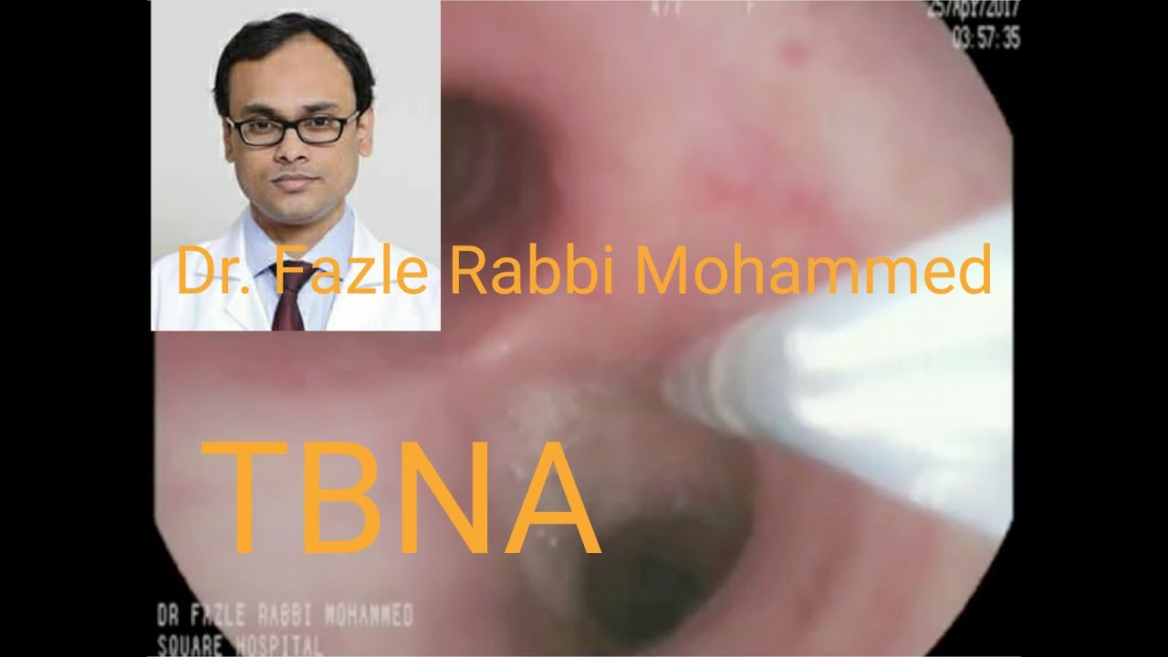 Transbronchial Needle Aspiration (TBNA) by Dr. Fazle Rabbi Md at SQUARE ...