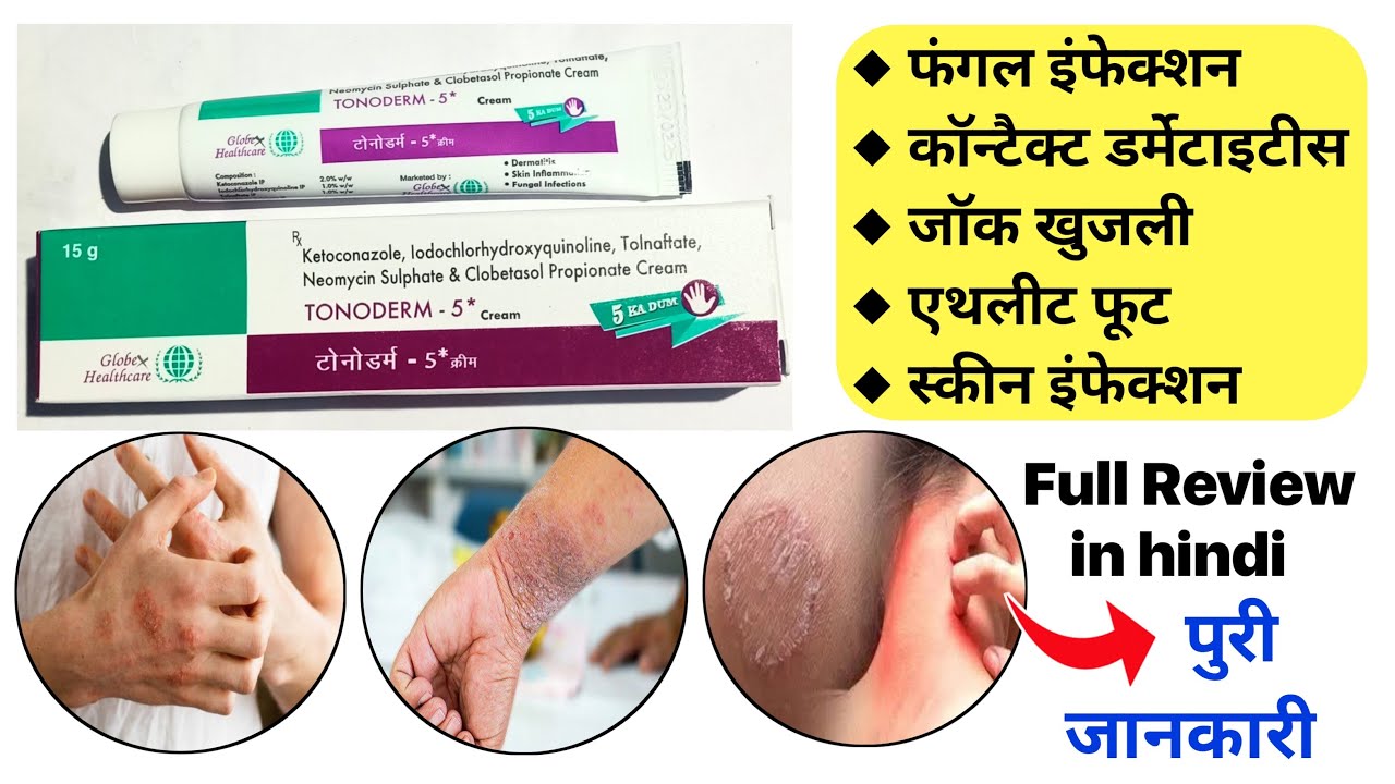 tonoderm 5 cream side effects | tonoderm 5 cream uses hindi | tonoderm ...