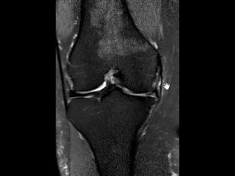 MCL bursitis - YouTube