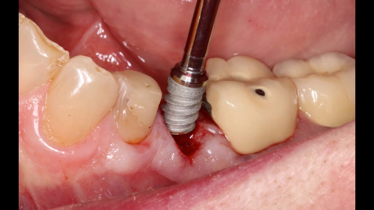 Atraumatic Extraction & Placement of OsteoGen® Bone Grafting Plug ...