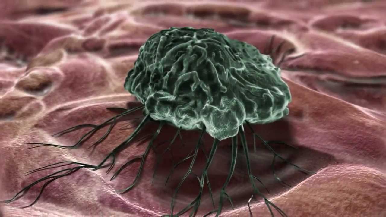 Define of Heart Cancer - YouTube