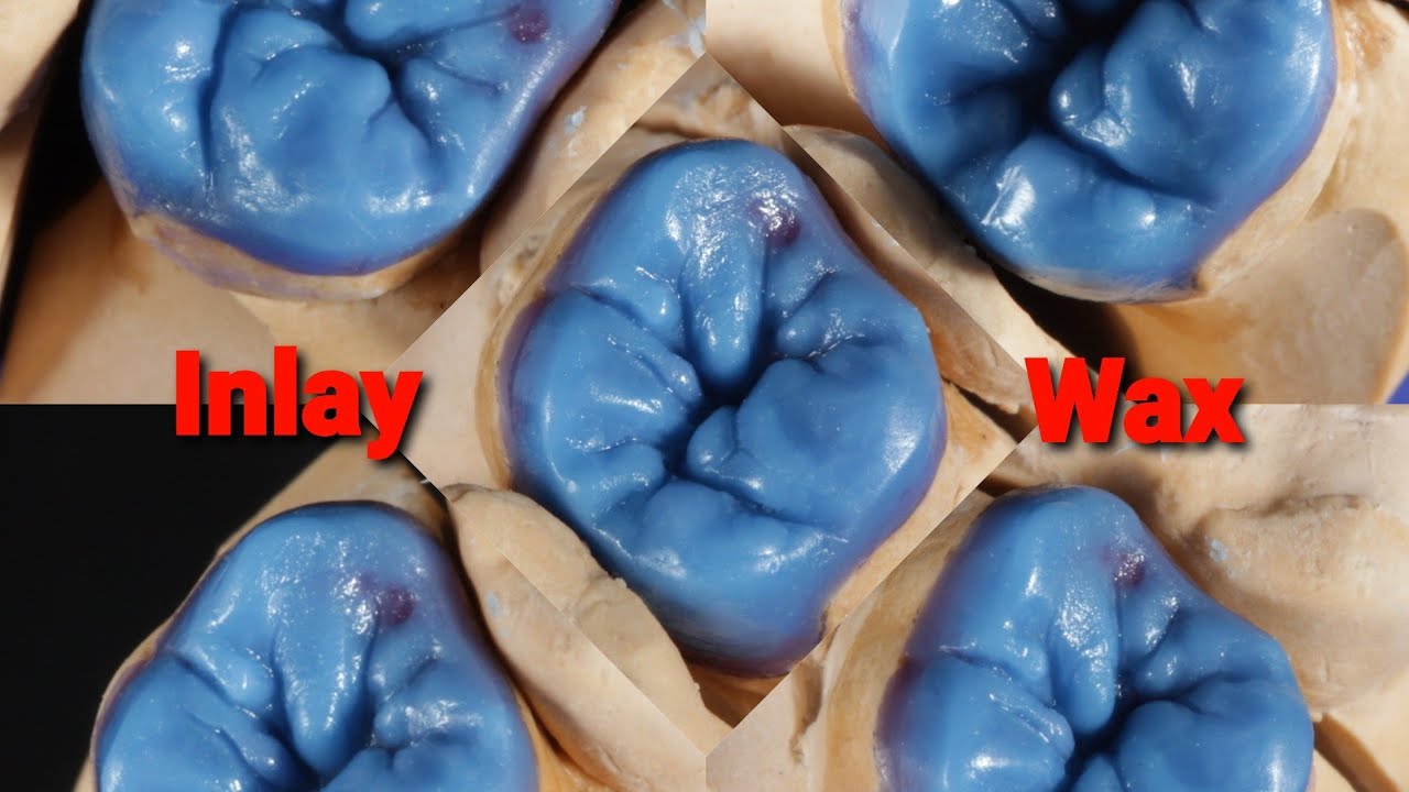Easy Steps to Do Upper Second Molar Inlay Wax-Up - YouTube