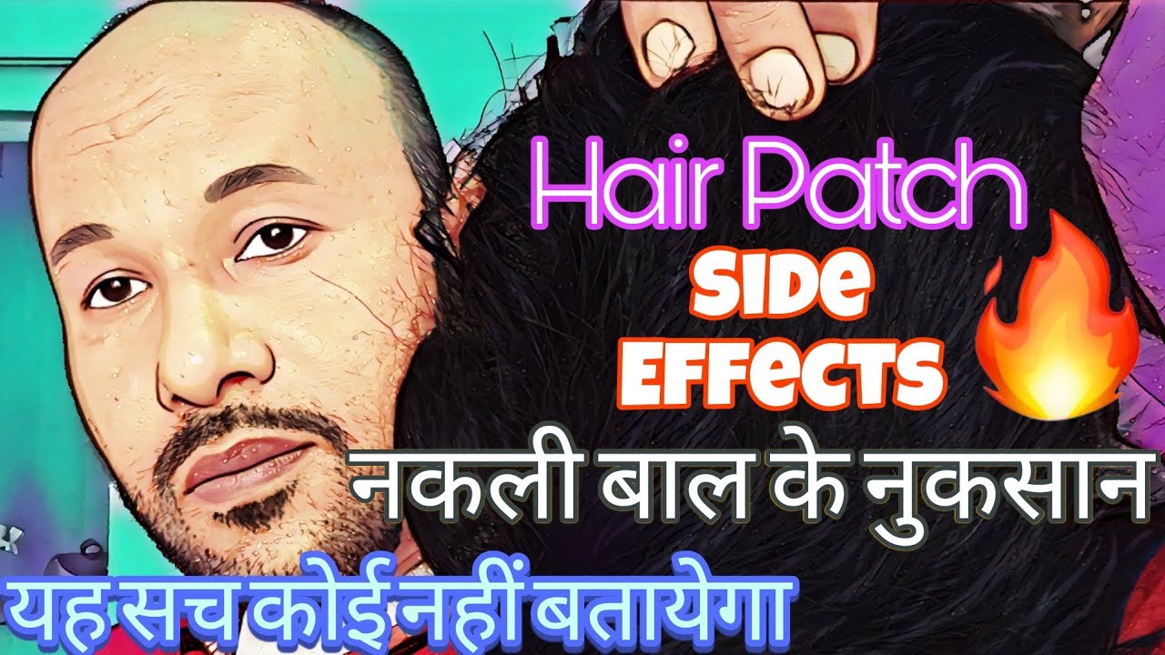 Hair Patch Side Effects || hair patch side effect in Hindi - YouTube