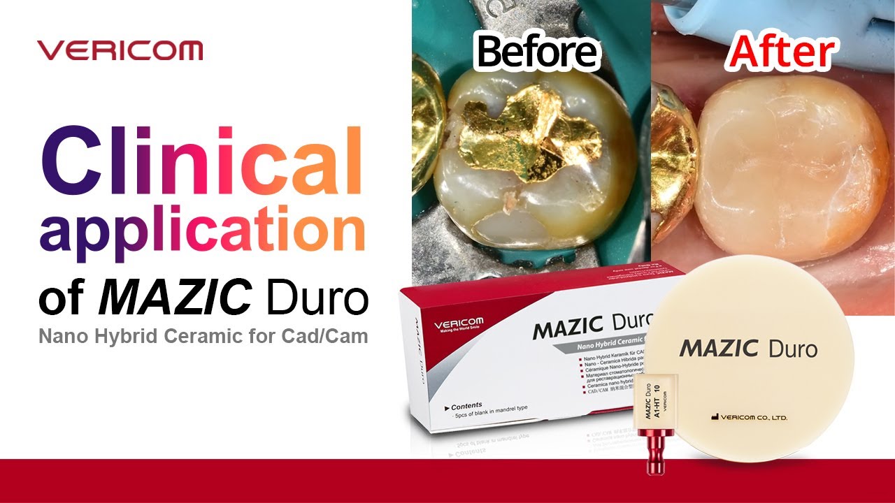 Clinical application of MAZIC Duro_Dr. Bae - YouTube