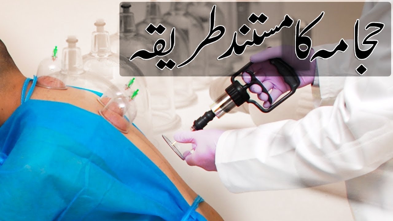HIJAMA (Wet Cupping) Procedure | BENEFITS OF HIJAMA BY DR SOHAIL ZAFAR ...