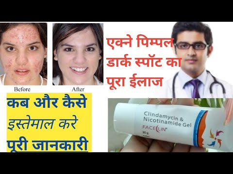 Clindamycin phosphate & Nicotinamide gel | Faceclin Gel Review | Best ...