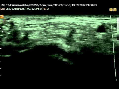median nerve movement - YouTube