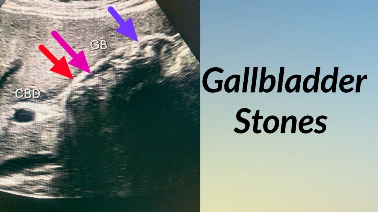 Gallbladder Ultrasound | Gallbladder with Multiple Stones | Ultrasound ...