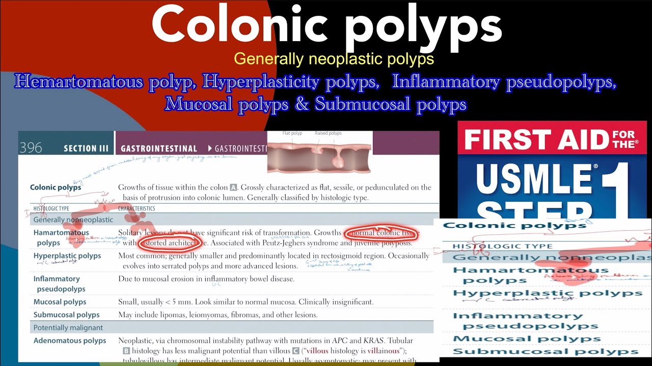 Colonic polyps- Hamartomatous polyps, Hyperplastic polyps, Inflammatory pseudopolyps, Mucosal ...