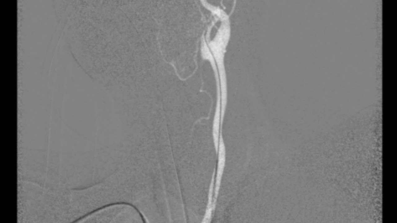 Transradial Cerebral Angiography -5 - YouTube
