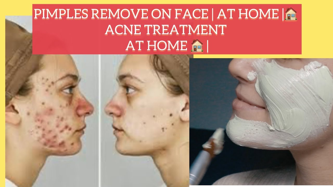 Pimples Remove on Face | at home |🏠 Acne Treatment at Home 🏠 | - YouTube