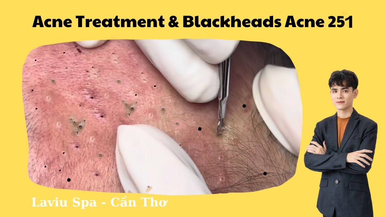 Acne Treatment - Blackheads Acne Removal - MỤN 251 - YouTube