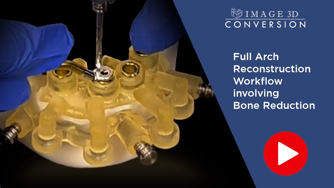 Full Arch Reconstruction Workflow Involving Bone Reduction - YouTube