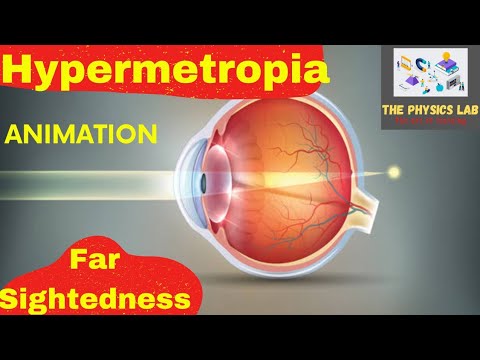 Hypermetropia | Eye Defect | with Animation - YouTube