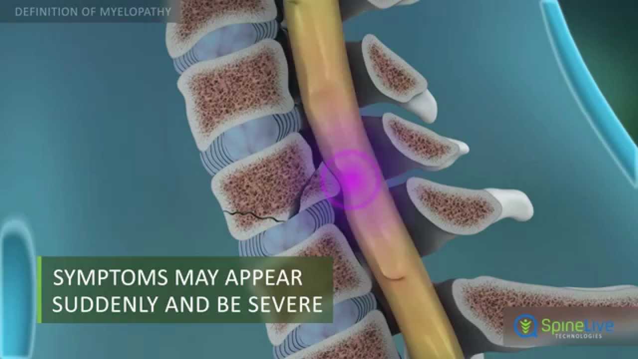 Myelopathy Definition - YouTube